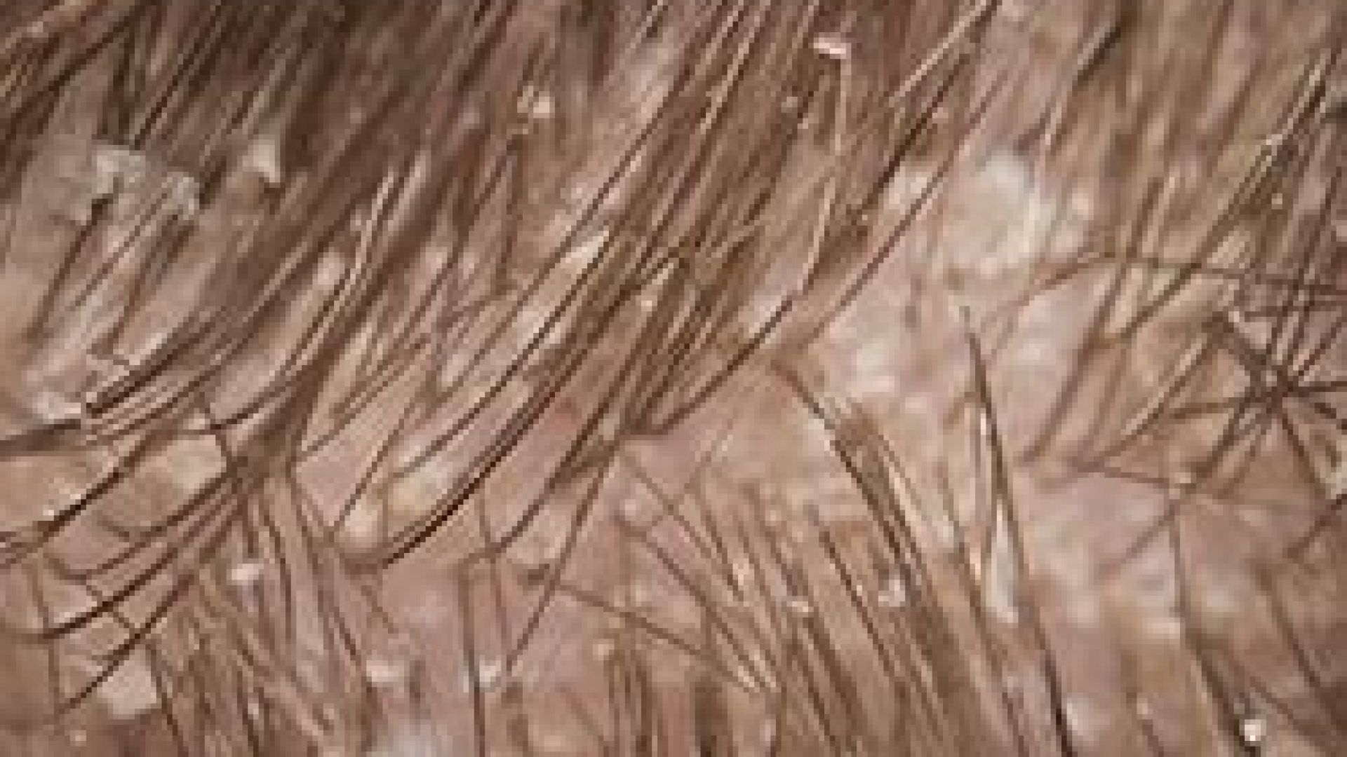 6 Easy Remedies to Control Your Winter Dandruff | NaturallyCurly